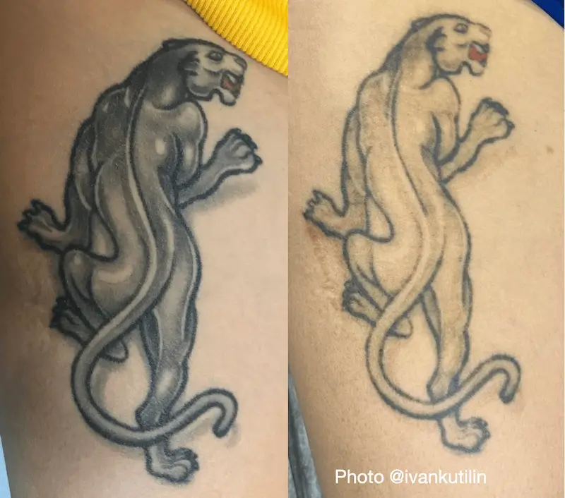Why do Tattoos Fade Unevenly After Laser Removal? – Laser Blog